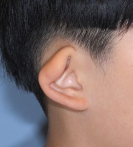 Procedures - Ear Surgery Korea